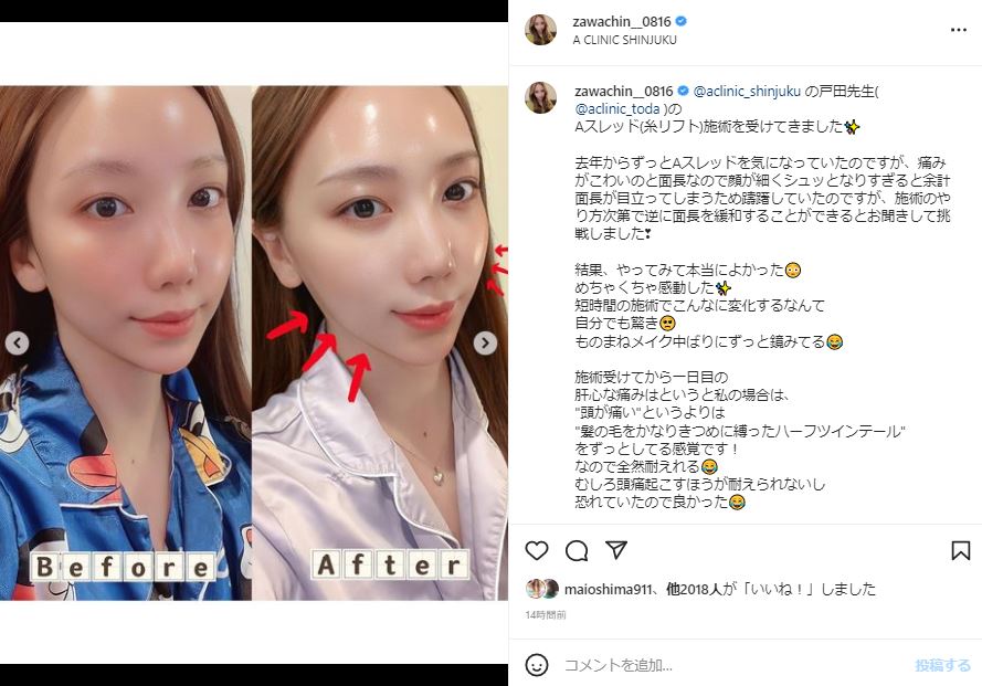 ざわちん、美容整形のビフォーアフターに大満足 気にしていた面長緩和で「メイク中ばりに鏡みてる」「自分でも驚き」 (l_zawachin ...